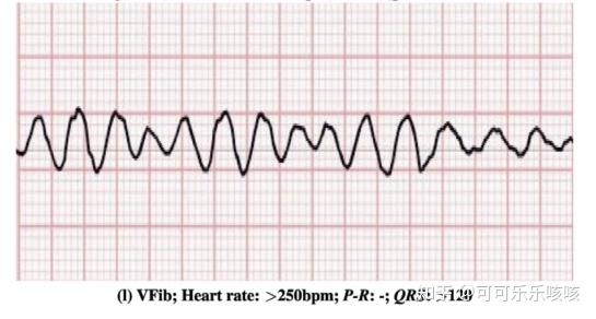 deep learning methods for ECG arrhythmia classification - 知乎