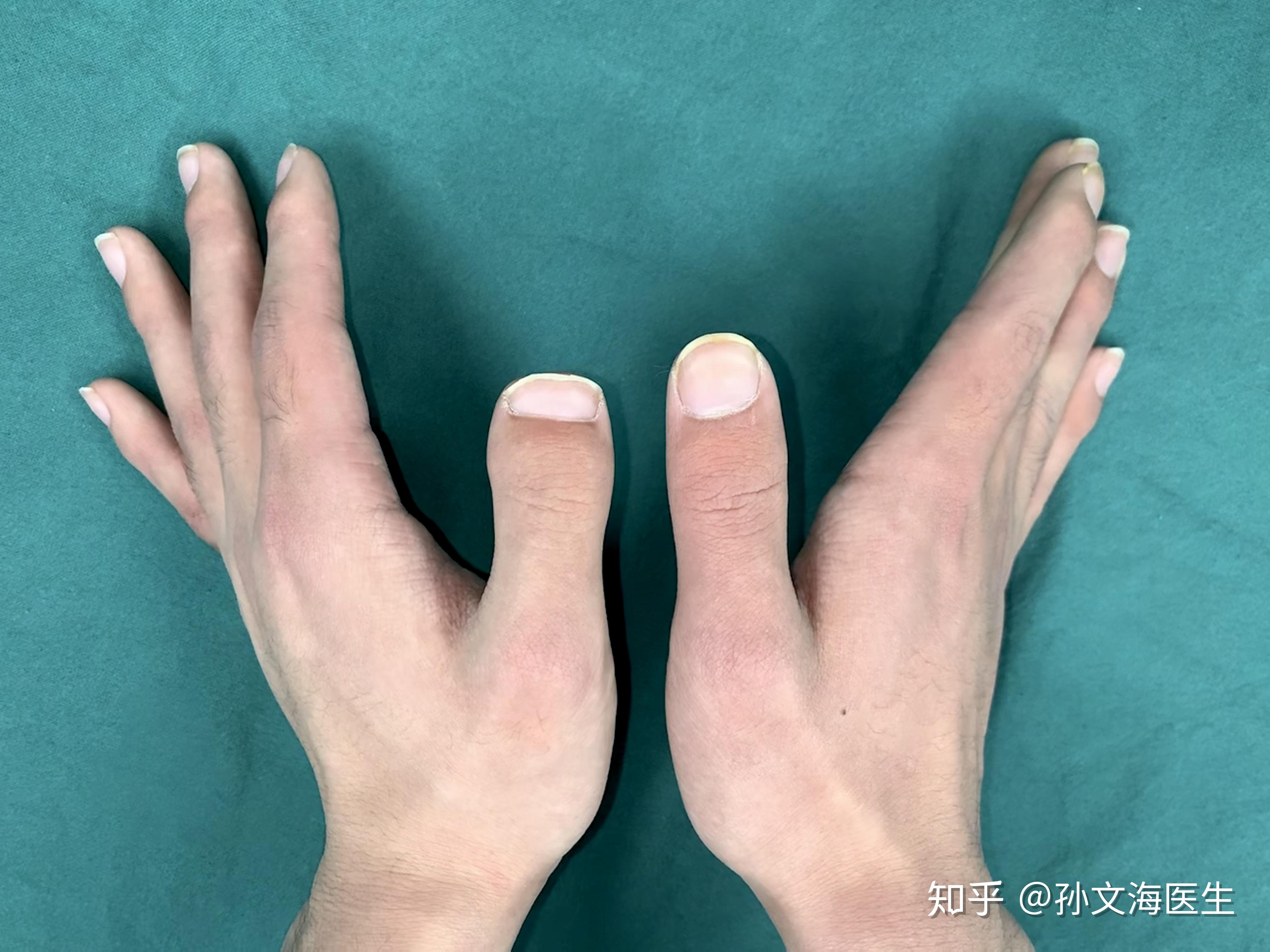 为什么我的大拇指又宽又短？ 知乎
