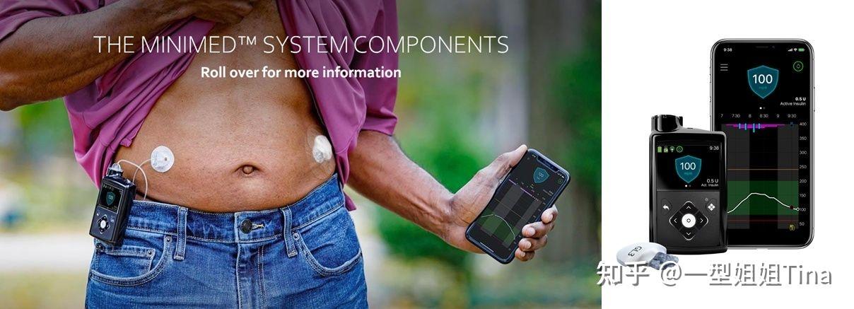 更轻便的人工胰腺Omnipod 5：无管路+手机控制的商业化闭环系统 - 知乎