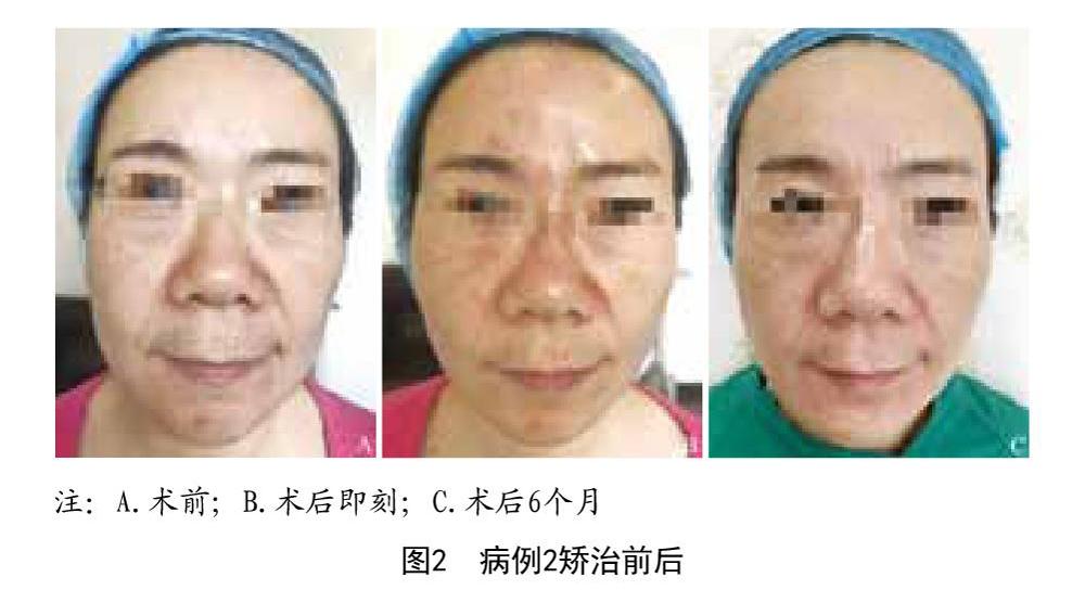 知乎盐选 | PPDO 双向锯齿线皮下埋置面部提升术的临床应用