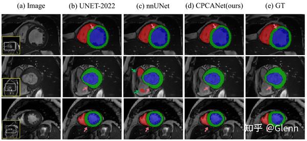 [论文阅读] MedSeg | CPCA：解决通道权重分配一致化的新型注意力机制 - 知乎