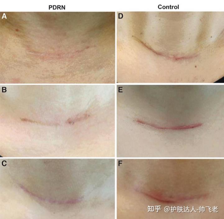 PDRN是什么？ - 知乎