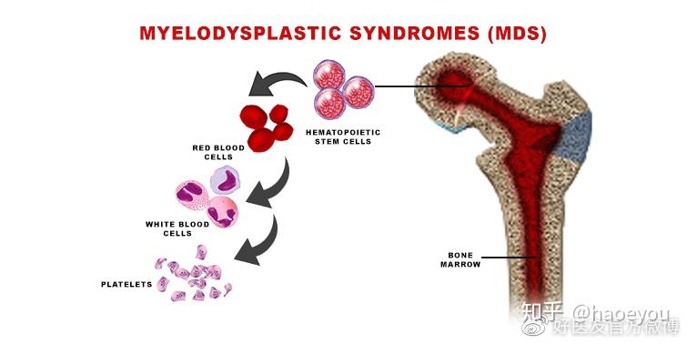 总缓解率91%！新疗法有望破解高危MDS治疗难题 - 知乎