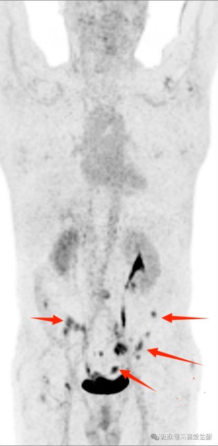 核医医生的“得力助手”！FAPI-PET/CT精准捕捉腹膜转移癌 - 知乎