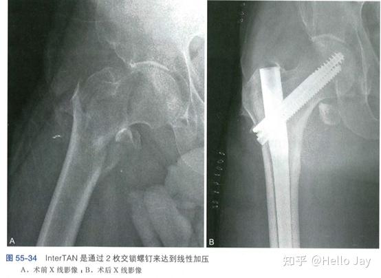 股骨转子间骨折 - 知乎