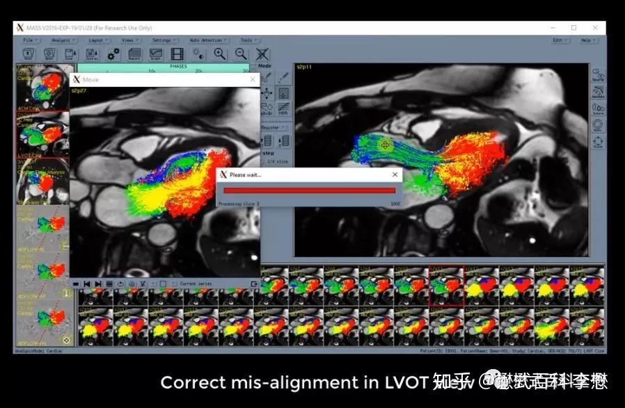 心脏磁共振技术大全（四） - 知乎