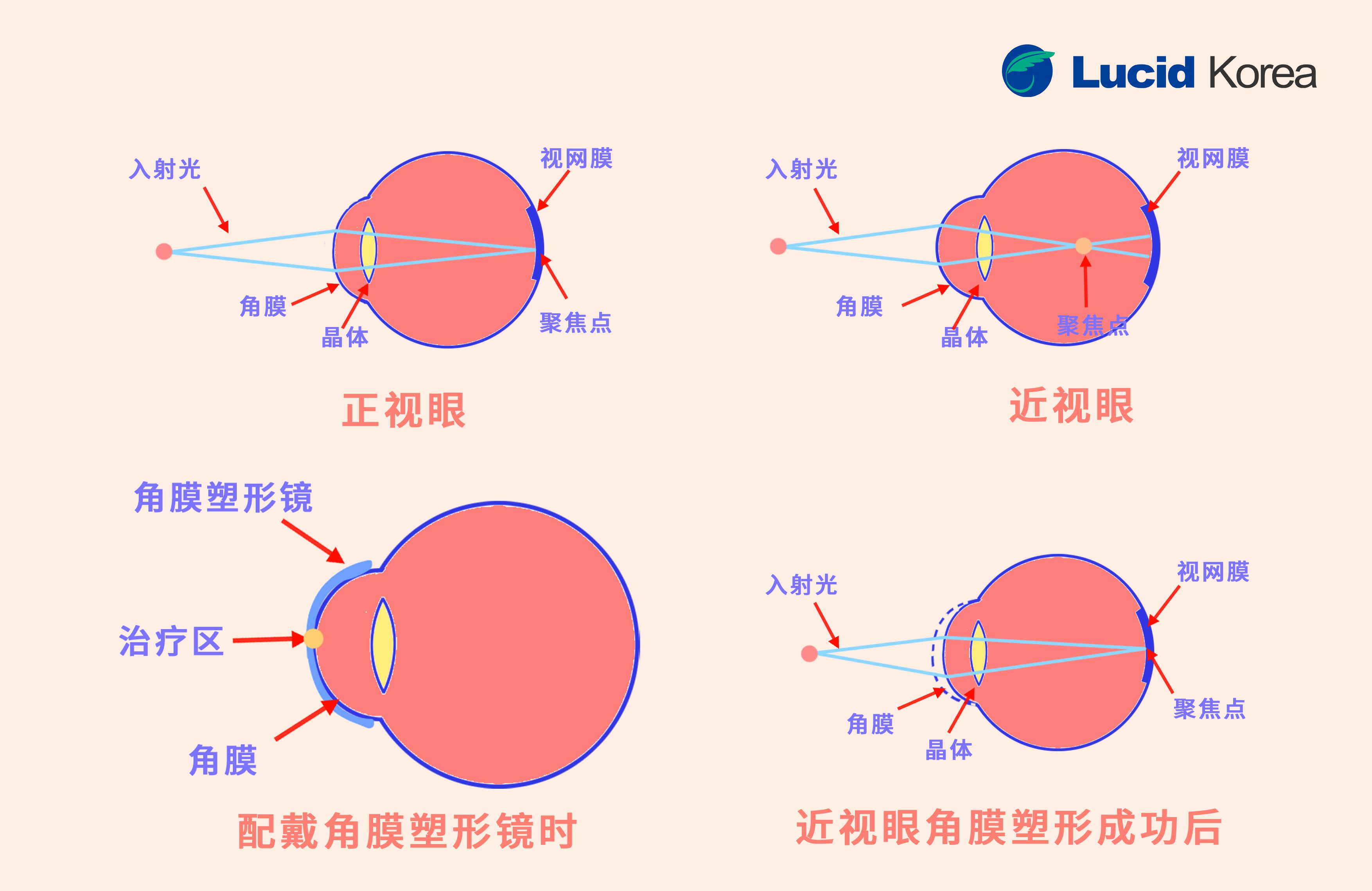 OK镜到底有没有用？用处有多大？ - 知乎