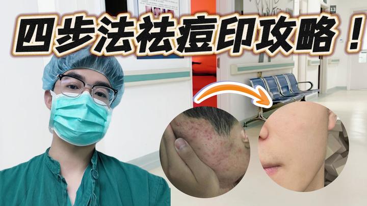 【男生祛痘印攻略】男生脸上爬满痘印丑到没朋友？有什么办法能祛除沉积已久的红黑痘印啊，看起来又脏又丑烦死了！专业医生教你 四步”淡化男生痘印，还你健康 妈生好皮”！ 知乎